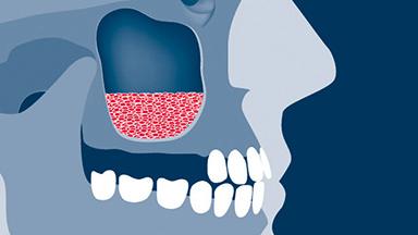Principles of Sinus Floor Elevation - Assessments - Home - ITI