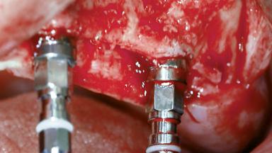 Bilateral Implant Placement with Simultaneous SFE: Lateral Window ...
